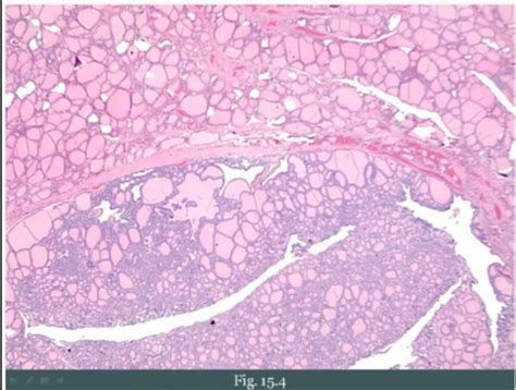 Thyroid Gland Flashcards Quizlet