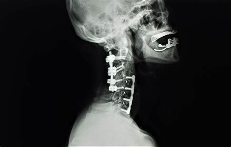 35 Facts About Cervical Vertebral Fusion
