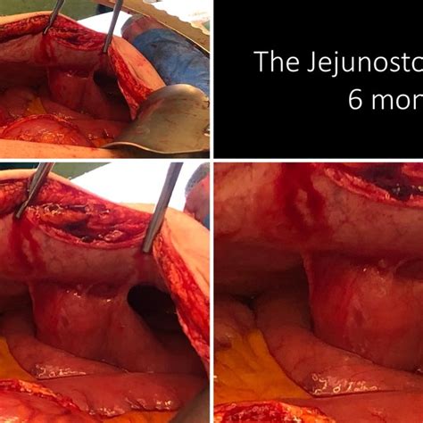The Jejunostomy After 6 Months Download Scientific Diagram