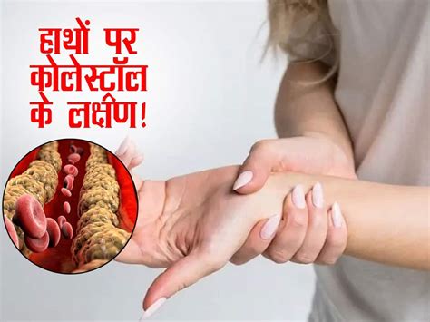 High Cholesterol Warning Signs On Hand हाई कोलेस्ट्रॉल की परेशानी में
