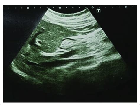 An Optimal Quality Image Of Antral Csa Obtained After Ingestion Of 100