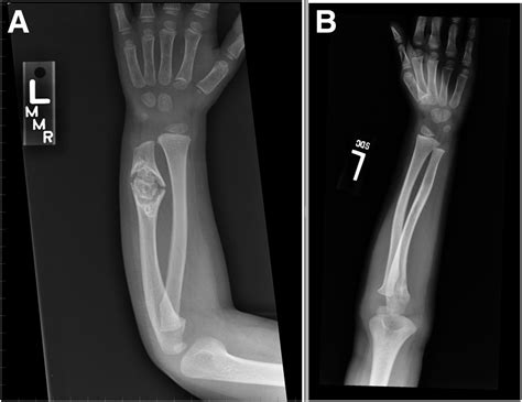 Broken Left Forearm X Ray