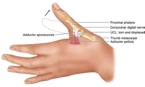 Reconstruction Of Acute And Chronic Ulnar Collateral Ligament Injuries
