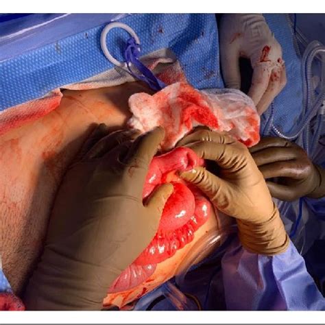Segmental Resection Of Small Bowel Including Md Download Scientific