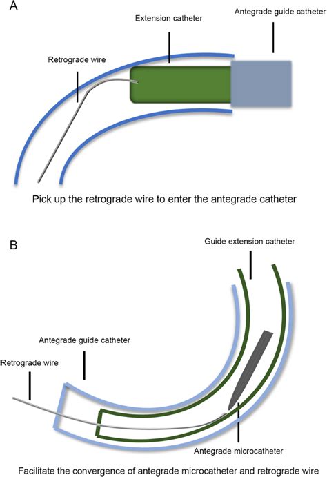 Depiction Of Guide Extension Catheter Facilitated Tip In Technique A