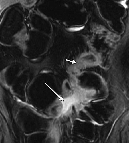 What Is Interloop Abscess Crohns Disease Of The Small Bowel Rikcxq