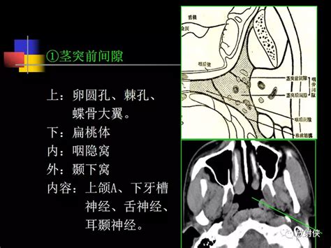 收藏必备 鼻咽部的ct详细解剖 知乎