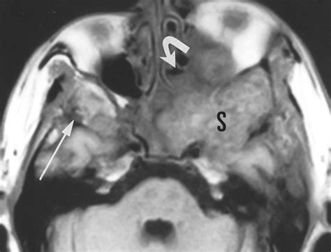 Greater Wing Of Sphenoid Radiograph