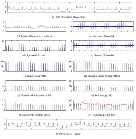 R Peak Detection Method Using Wavelet Transform And Modified Shannon