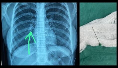 Dr Tamoor Khan Wazir On Linkedin Otorhinolaryngology