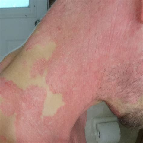 Cure Psoriasis Naturally Neck Right A Warrior Curing Psoriasis Naturally