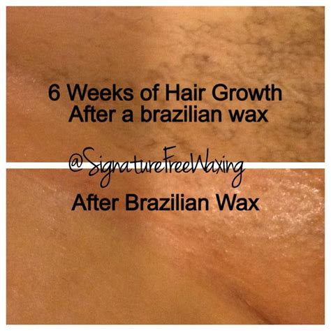 Top Photo 6 Weeks After Receiving A Brazilian Wax At Signature Free Waxing Bottom Photo After