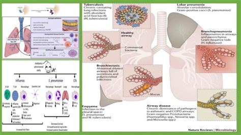 Secondary Pulmonary Infections Download Scientific Diagram