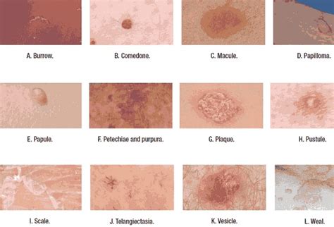 Skin Lesions Sydney Cosmetic Specialists