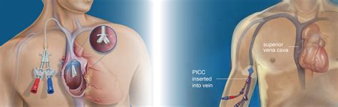 What Is A Tunneled Central Venous Catheter Used For