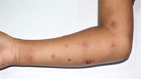 Angela Ragin Wilson Phd On Linkedin Risk For Mpox Resurgence Rises