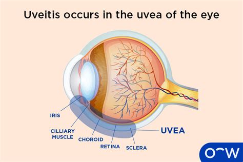 Uveitis Definition