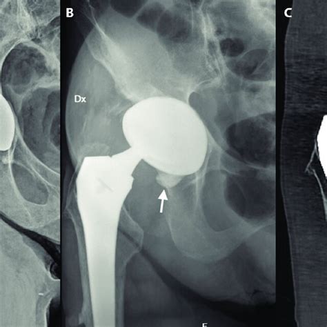 Radiograph 3 Years After Double Socket Acetabular Revision Showing Download Scientific