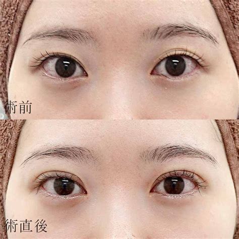 二重埋没法の症例写真・ビフォーアフター Ι 執刀医：眞鳥 優規 美容整形なら水の森美容クリニック
