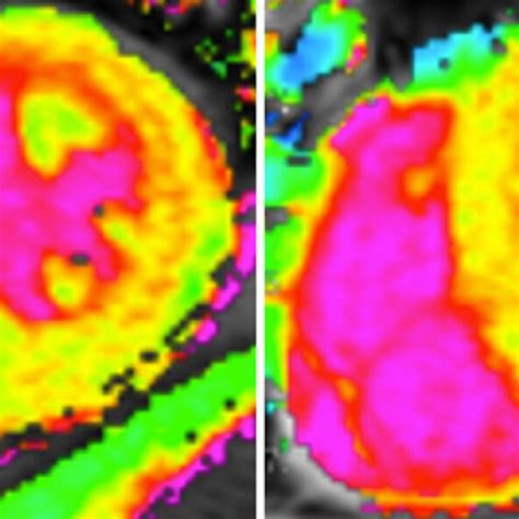 Tafamidis Zur Behandlung Der Transthyretin Amyloid Kardiomyopathie