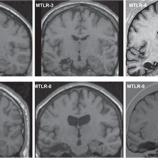 Example Images Of Unilateral Lesions Of The Medial Temporal