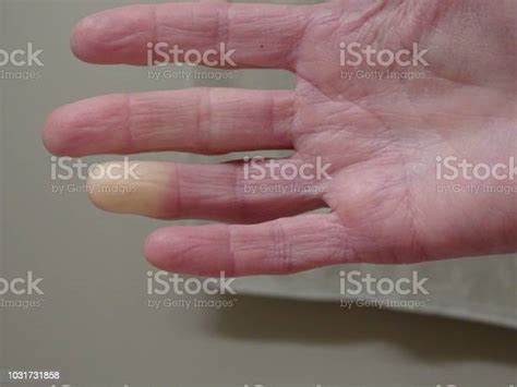 성인 손 Raynaud의 증후군 손가락에 대한 스톡 사진 및 기타 이미지 손가락 신경병 간호사 Istock
