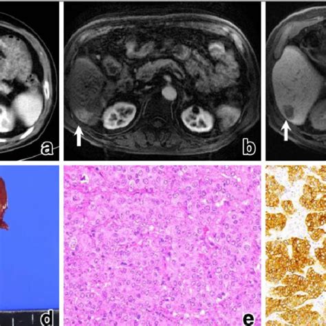 A Contrast Enhanced Abdominal Ct Shows A Weakly Enhanced Mass