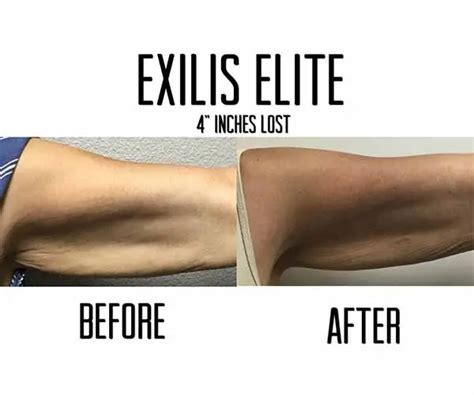 Exilis Sage Wellness