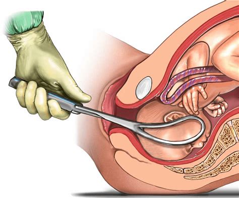 Forceps Delivery Jogal Womens Hospital