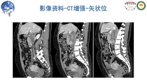 病例腹膜后下腔静脉平滑肌肉瘤1例CT 影像PPT