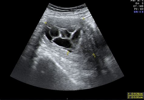 Chapter 2 Uterine Fibroids Melaka Fertility