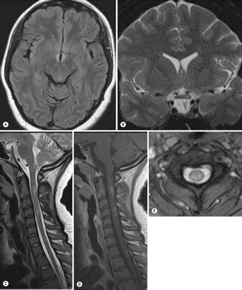 Non Tumoural Spinal Cord Lesions Clinical Tree