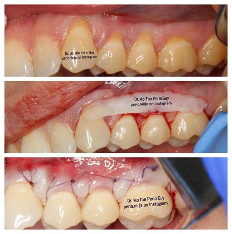 Mohammad Ahmad Javaid On Linkedin Periodontal Regenerative Procedure