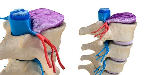 Hernie Discale Lombaire Docteur Chiffolot Chirurgie Du Rachis