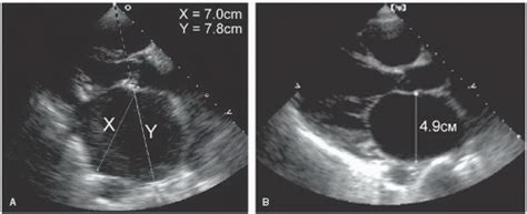 Left And Right Atrium And Right Ventricle Thoracic Key