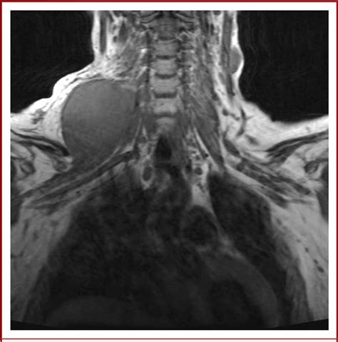 Figure 1 From Brachial Plexus Reconstruction Following Resection Of A