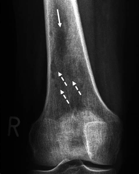 The Lodwick Classification For Grading Growth Rate Of Lytic Bone Tumors