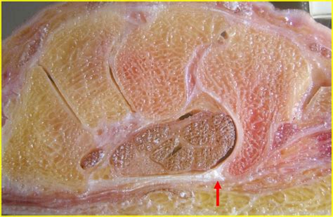 Calcium Pyrophosphate Dihydrate Cppd Crystal Deposition Disease Radsource