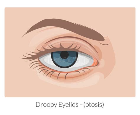 Ptosis Drooping Upper Eyelid Stock Illustration Stock Illustration
