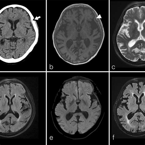 Patient 1 Axial Non Contrast Enhanced Ct Brain Scan Revealing A Left