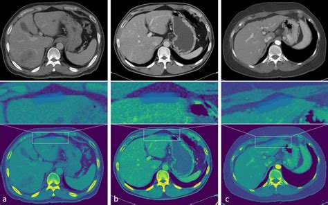 Examples Of Hepatic Surface Nodularity Measurement From Portal Venous