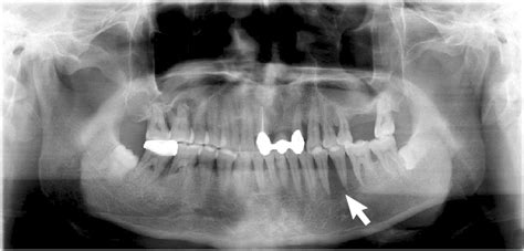 Panoramic Radiograph Shows Diffuse Radiolucency At The No 34 35 36 Download Scientific