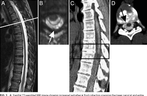 Figure 1 From Posterior Thoracic Laminoplasty With Dorsal Intradural