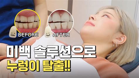대신해주는 시술 리뷰 치아미백 피부 시술의 모든 정보 여신tv