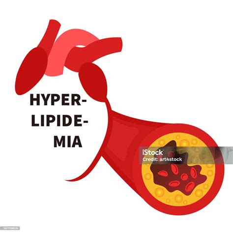 Hyperlipidemia Conceptual Illustration Stock Illustration Download