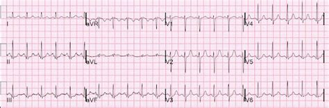 Dr Smiths Ecg Blog Atrial Repolarization Wave Mimicking St Depression