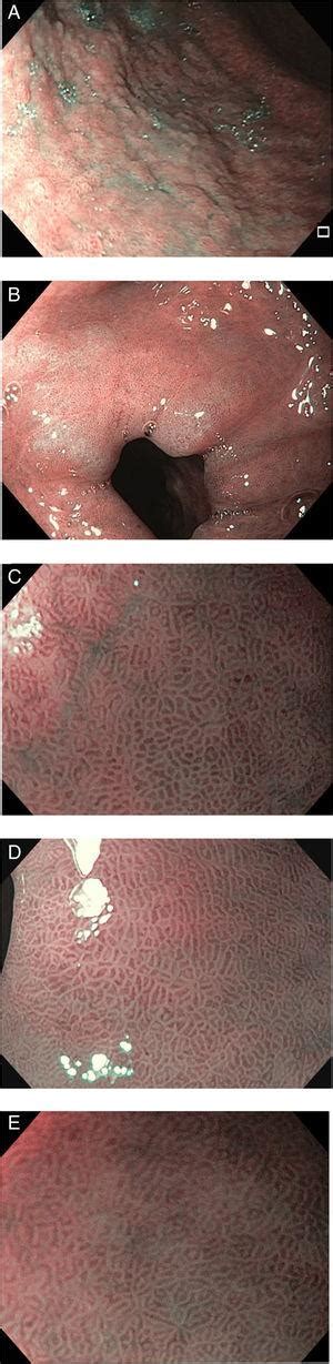 Efficacy Of Narrow Band Imaging For Detecting Intestinal Metaplasia In