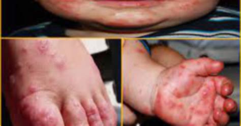 958 Kes Penyakit Hmfd Di Negeri Sembilan Berita Harian