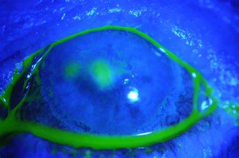 Keeping Up With Keratitis