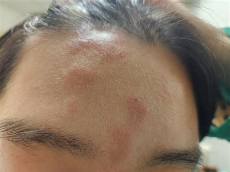 3주된 피부 병변 두피부터 이마 볼에 붉은 반점 지식in